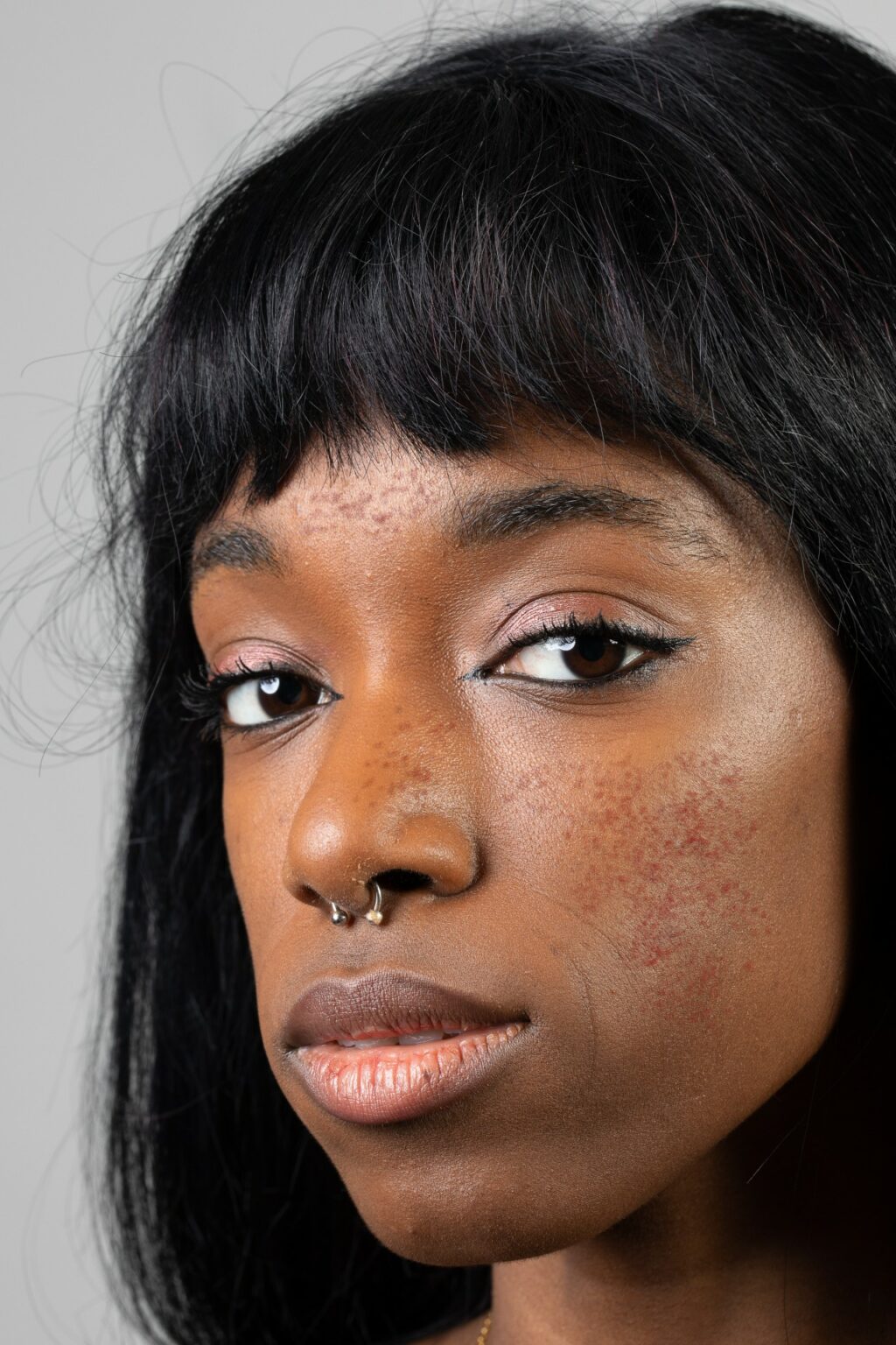 Does Rosacea Affect Those with Darker Skin Tones? - Buckhead Dermatology