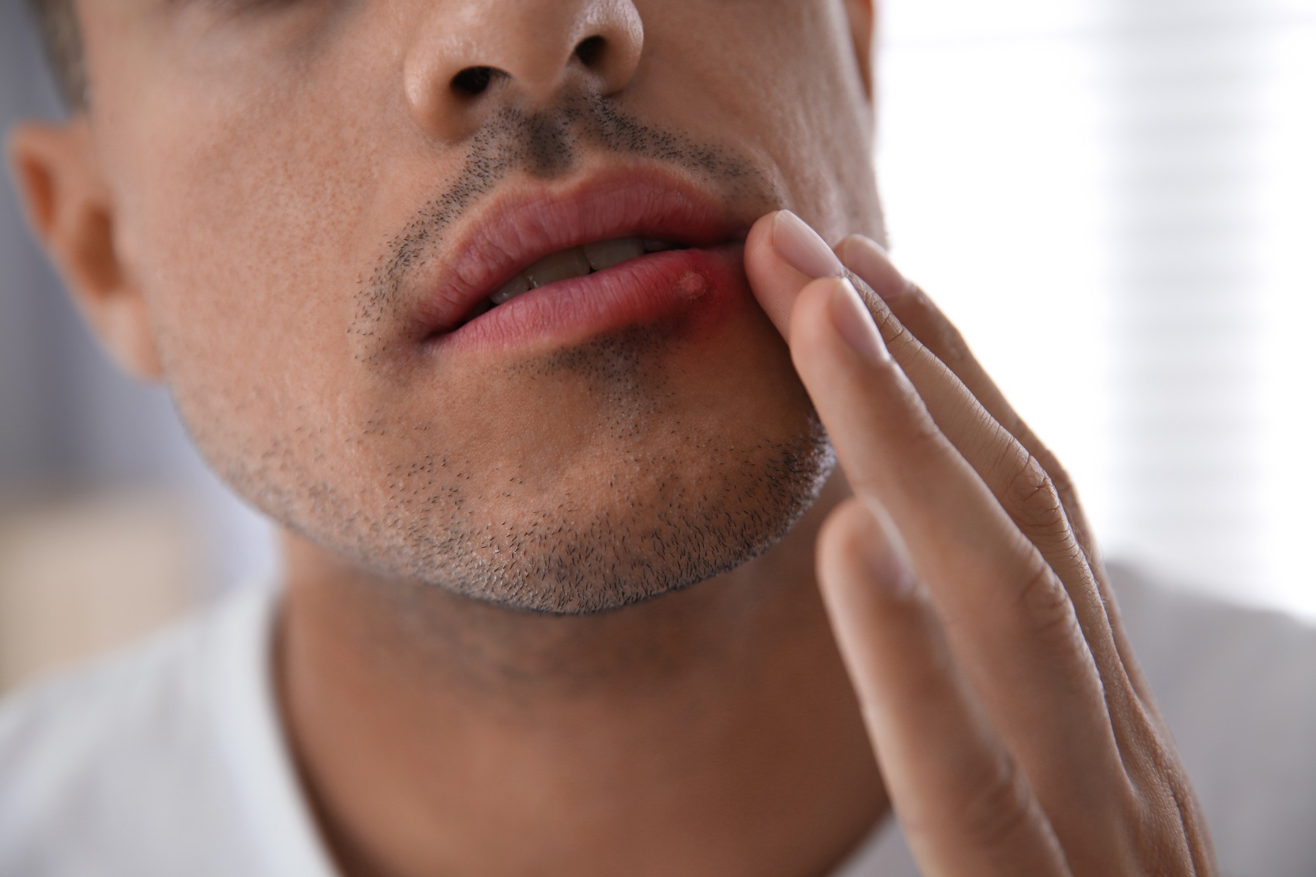 Treating the Herpes Simplex Virus - Buckhead Dermatology