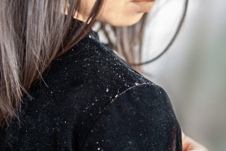 What is Dandruff and How Can You Treat It - Buckhead Dermatology