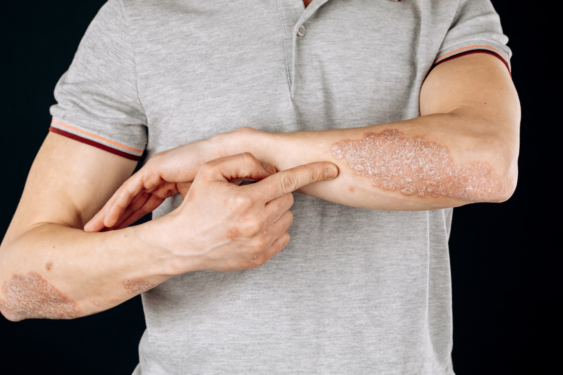 Active Psoriasis Care Makes a Difference - Buckhead Dermatology