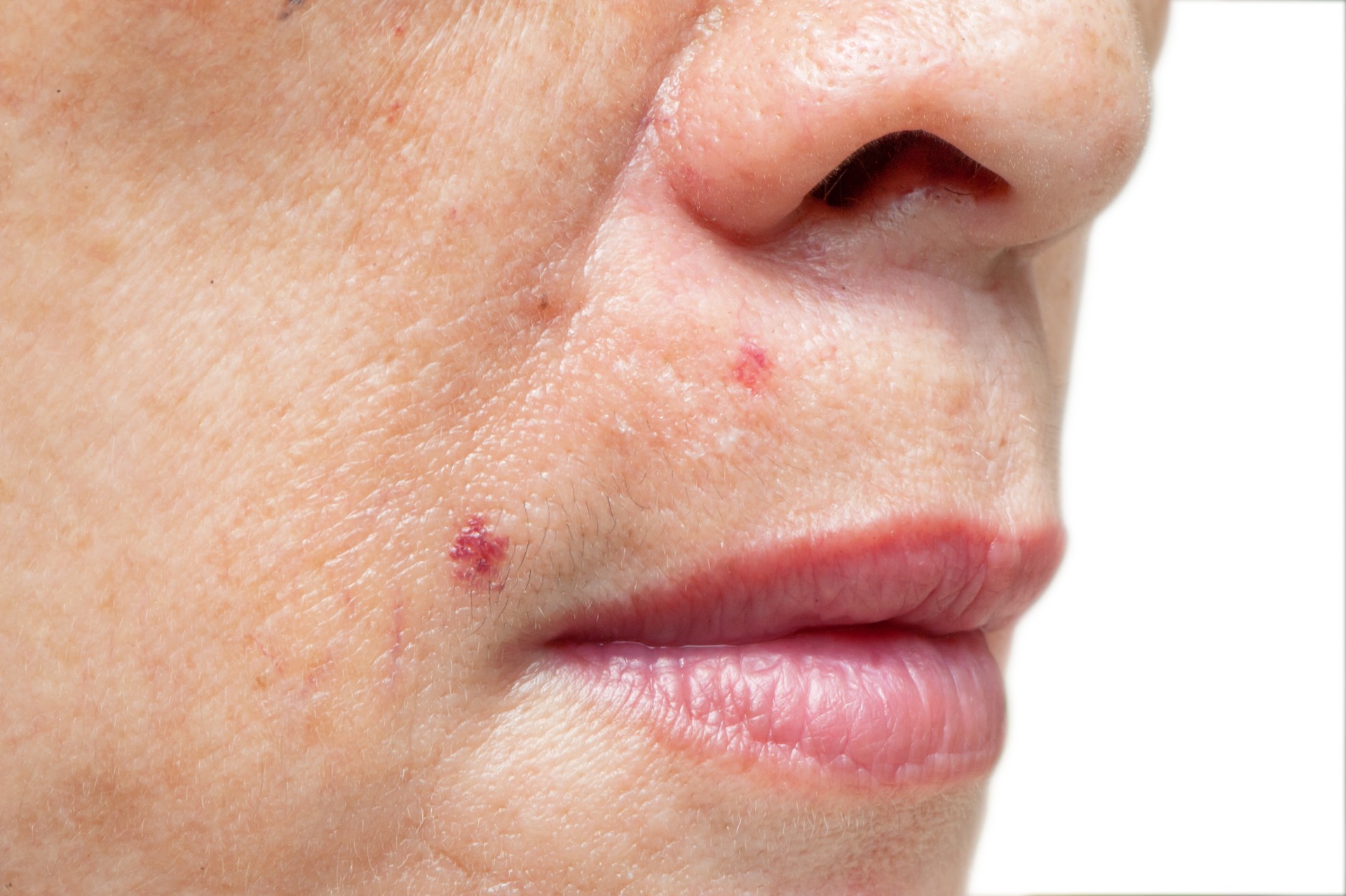 Identifying and Treating Petechiae and Other Bruising Skin Conditions
